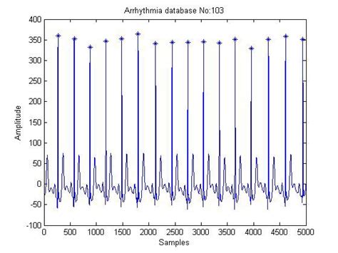 Ecg R Peak Detection Download Scientific Diagram