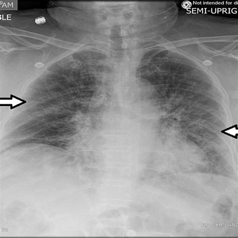 Chest X Ray On Admission Showing Bilateral Lung Opacities And Download Scientific Diagram