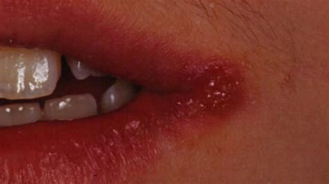 Cheilite Angolare Cause Diagnosi E Terapie Per Un Problema Complesso