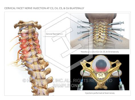 Cervical Facet Joint Nerve Injection