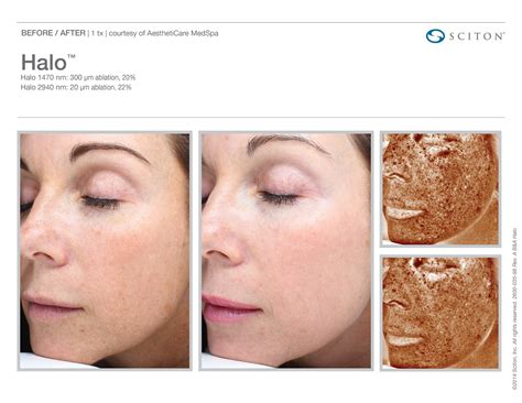 Halo™ Laser Treatment Minneapolis Edina Minnetonka