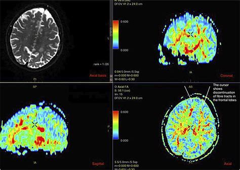 An Example Of Diffusion Tensor Imaging MRI In A Patient With Dementia Download Scientific Diagram
