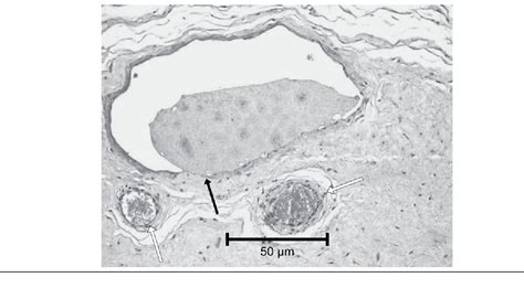 Figure 3 From Lymphatic Obstruction Semantic Scholar