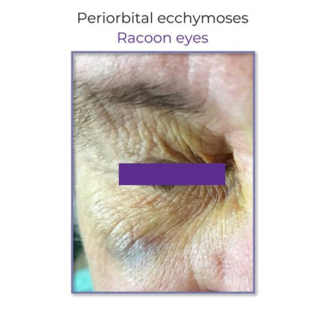 Clinical Pathology Glossary Ecchymosis Ditki Medical And Biological