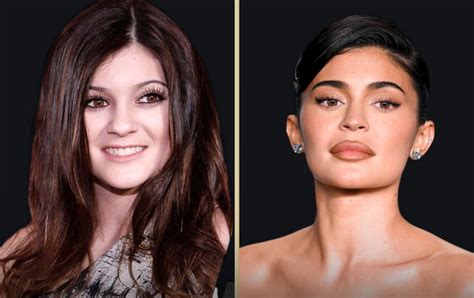 Kylie Jenners Plastic Surgery Journey Before And After Rememore