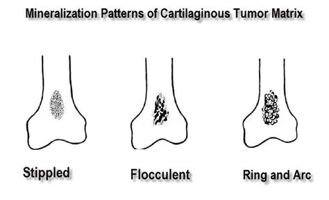 Tumor Mineralization Patterns Bone And Spine