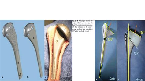 Fracture Proximal Humerus Pptx