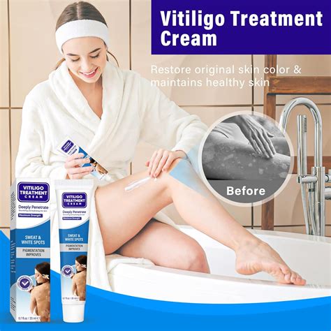 Plazala Crema De Vitiligo Tratamiento Natural Eficaz Para El Vitíligo