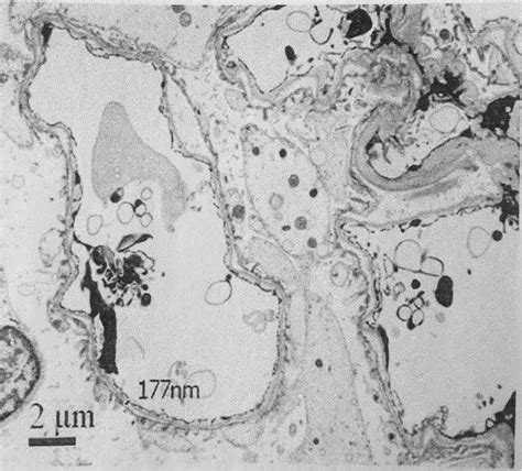Electron Microscopy In Renal Biopsy Specimen Diffuse Thinning Of Gbm Download Scientific