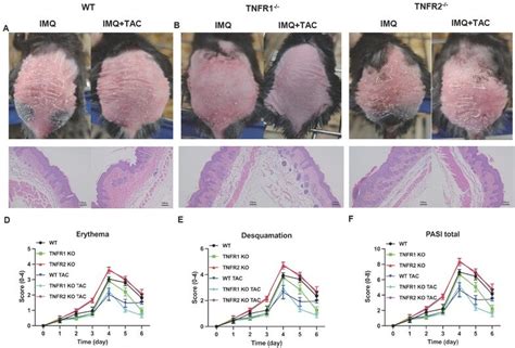 Tac Inhibits Imq Induced Psoriasis In Wt And Tnfr1 Mice But Not In Download Scientific