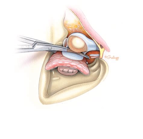 Lateral Temporal Bone Resection Oto Surgery Atlas
