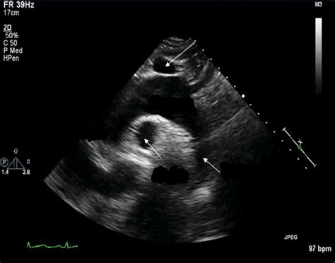 Suprasternal Notch — Printable Worksheet