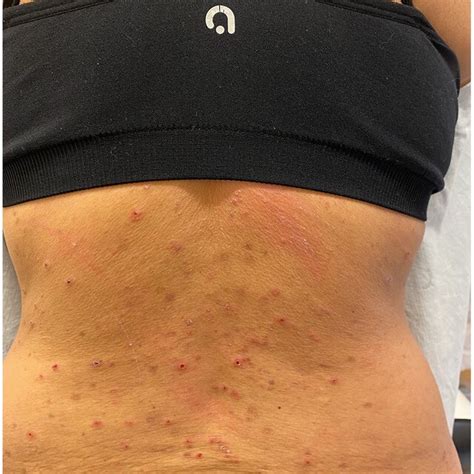 Recurrent Lichenoid Eruption Upon Rechallenge With Durvalumab Download Scientific Diagram