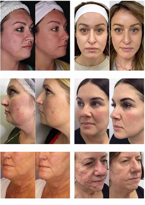 Morpheus8 Microneedling Facial Acne Scars Stretch Marks Treatment