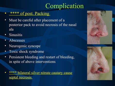 Epistaxispdf