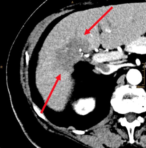 Case Study High Resolution Pcd Ct Imaging For Intrahepatic Cholangiocellular Carcinoma