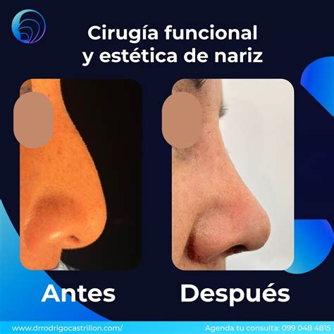 Luce Tu Nariz Ideal Y Armoniza Tu Rostro Con Una Rinoplastia 👃🏻 Dr