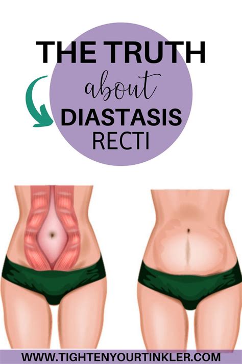 Best 9 The Truth About Diastasis Recti Heal And Get Rid Of The Pooch