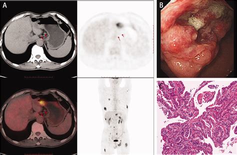 A A 18f Fluorodeoxyglucose Positron Emission Tomography Computed Download Scientific Diagram