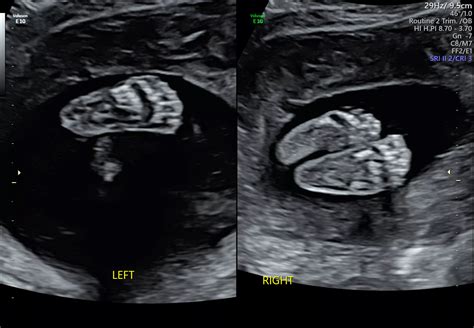 Spina Bifida 3d Ultrasound