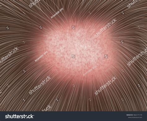 Medical Illustration Ringworm Scalp Stock Illustration Shutterstock