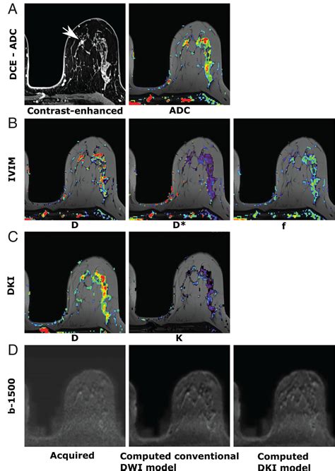 Diffusion Weighted Imaging DWI For Breast Lesion Characterization The Olea Medical