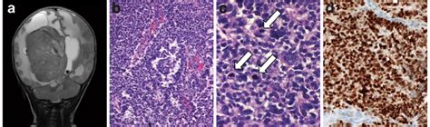 Large Choroid Plexus Carcinoma Arising In The Setting Of Lfs In An Download Scientific Diagram