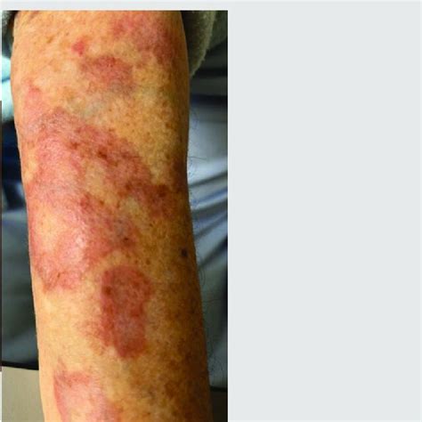 Erythematous Rash With Annular Discoloured Plaques In Both Forearms Download Scientific