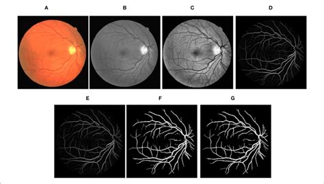 Stepwise Illustration Of Proposed Method A Color Retinal Fundus Download Scientific