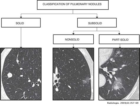 incidental pulmonary nodules characterization and management