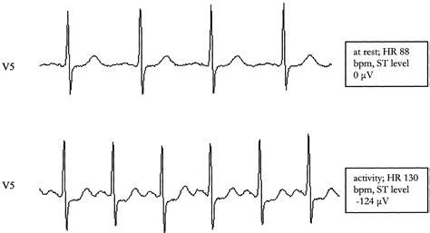 St Segment Depression