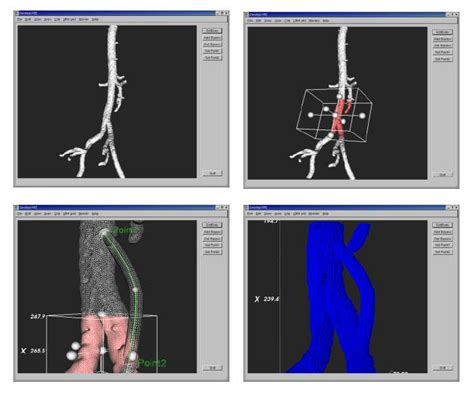 3 Segmented Data Rendering Bypass Creation And Lattice Boltzmann Mesh