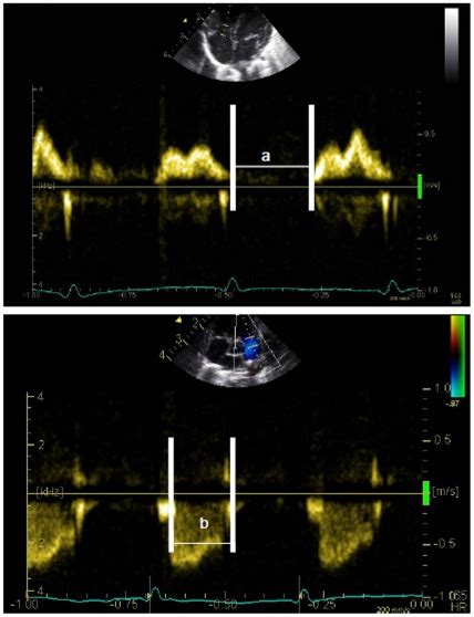 Measurement Of The Myocardial Performance Index By Pulsed Doppler In