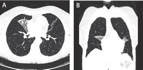 Nodularbronchiectatic Form Of Nontuberculous Mycobacterial Lung