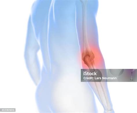 3d 렌더링의 관절염인간의 팔꿈치 관절에 류 마티스 관절염 류마티스관절염에 대한 스톡 사진 및 기타 이미지 류마티스관절염 0명 3차원 형태 Istock