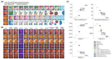 Segmenting Geographic Atrophy In Retinal Fundus Images A