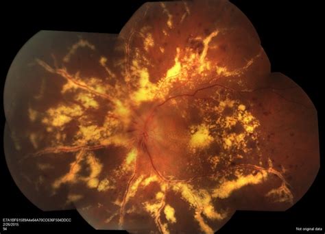 Diabetic Retinopathy Csme Exudates Nvd Color Fundus Photo Montage Retina Image Bank