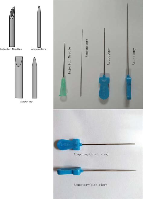 Figure 1 From Percutaneous Release Of The First Extensor Tendon