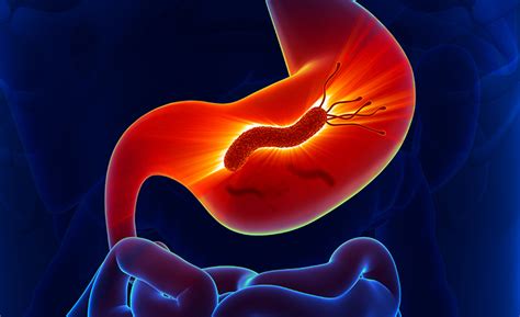 Rapid Detection Of H Pylori Stool Antigen