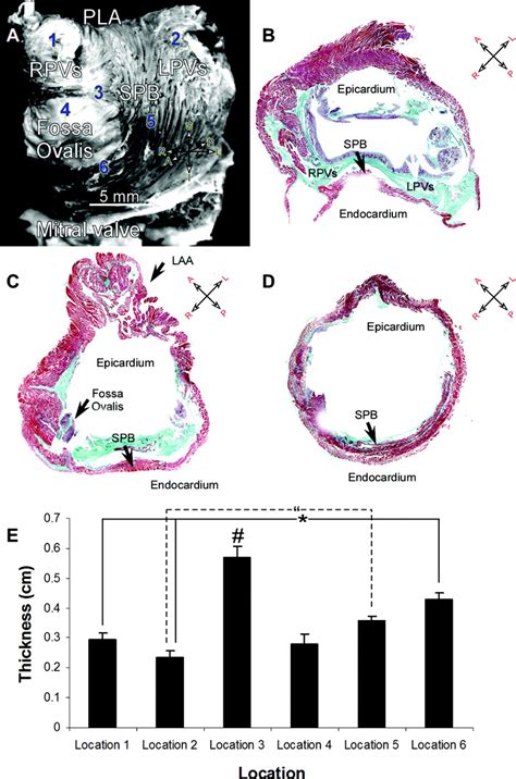 Atrial Septopulmonary Bundle Of The Posterior Left Atrium Provides A