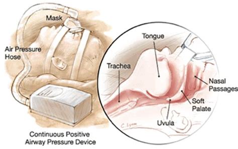 Cpap Parts Diagram