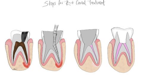 Apicoectomy Dental Procedure Things To Know 1311 Jackson Ave Dental