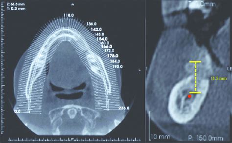Ct Scan Before Implant Placement Download Scientific Diagram