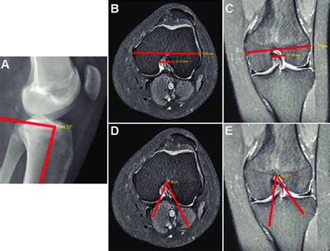 A Tibial Slope Measurement On True Lateral Radiograph B Axial And