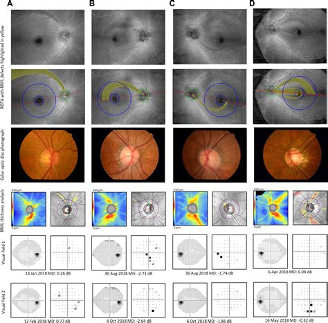 Retinal Nerve Fiber Layer Optical Texture Analysis Ophthalmology