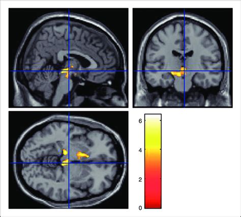 Voxel Based Analysis Whole Brain Voxel Based Analysis In The Migraine