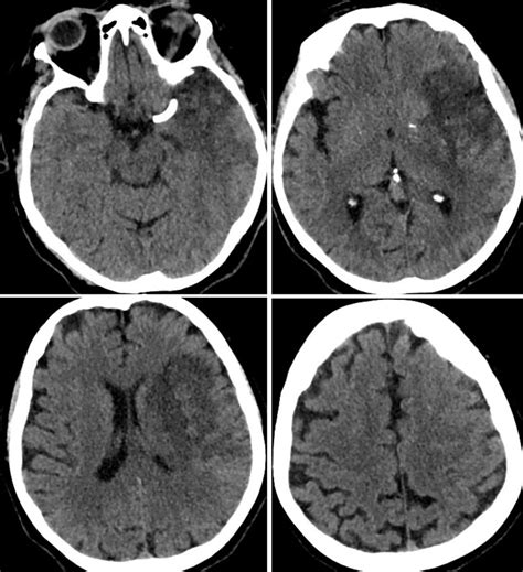 Rescue Thrombectomy In Post Procedural Fd Thrombosis