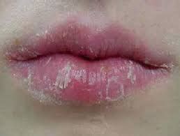 Queilitis Resequedad Y Grietas En Labios Que Es Aca Te Lo