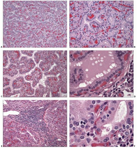 Diffuse And Nodular Hyperplasia Basicmedical Key