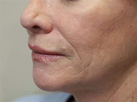 Lip Implant Before And After Photo Gallery Sacramento Ca Folsom